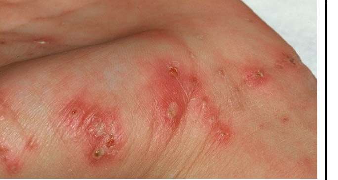 Scabies images